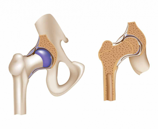 Optimised positioning system (OPS) in total hip replacement - Micheal ...