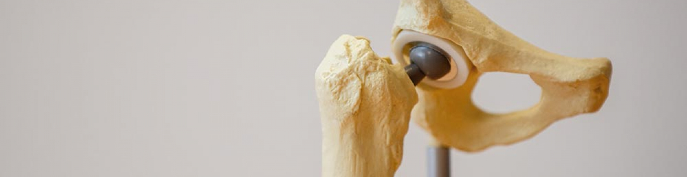 Optimised positioning system (OPS) in total hip replacement - Micheal ...