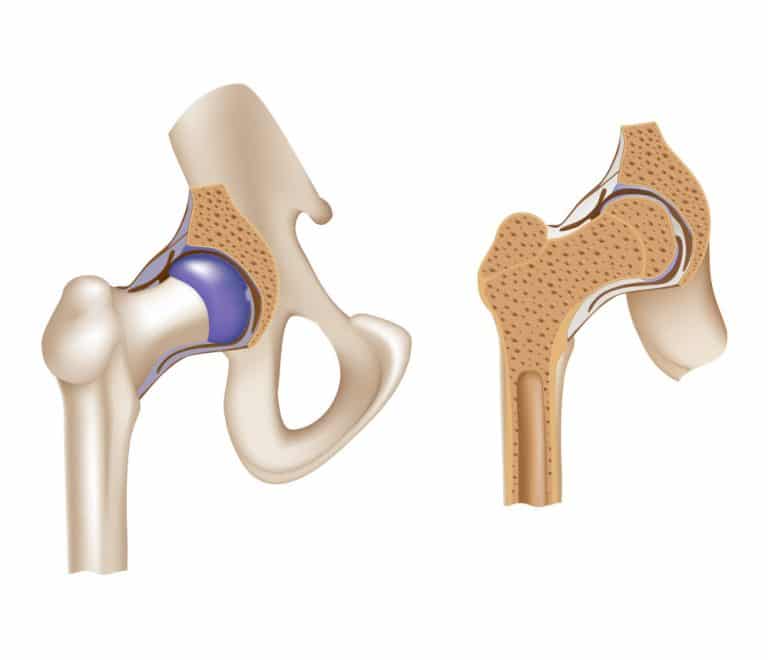 Total Hip Replacement surgery in Sydney by Dr Michael Stening